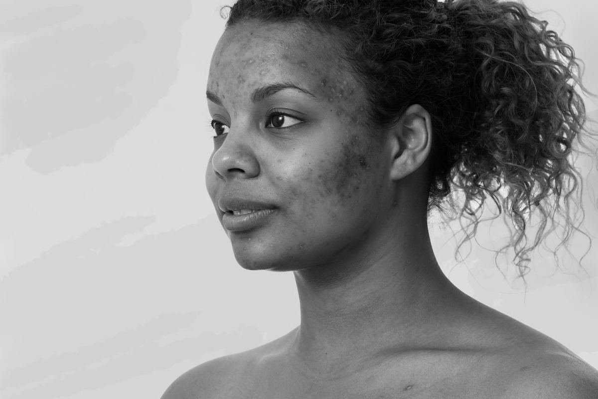 Acné de la femme adulte, causes et solutions pour en finir